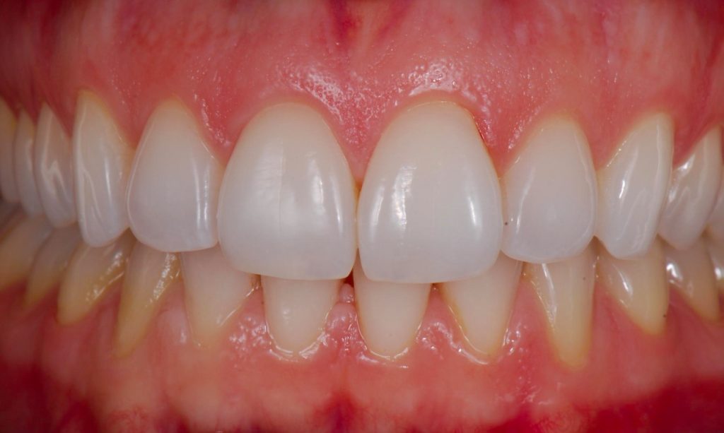 Pink Esthetic | Turkey | Sonodent Smile Clinic | Istanbul